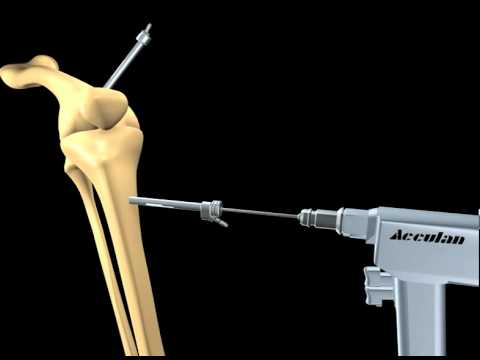 bicortical screws - Stefano Zanasi - YouTube