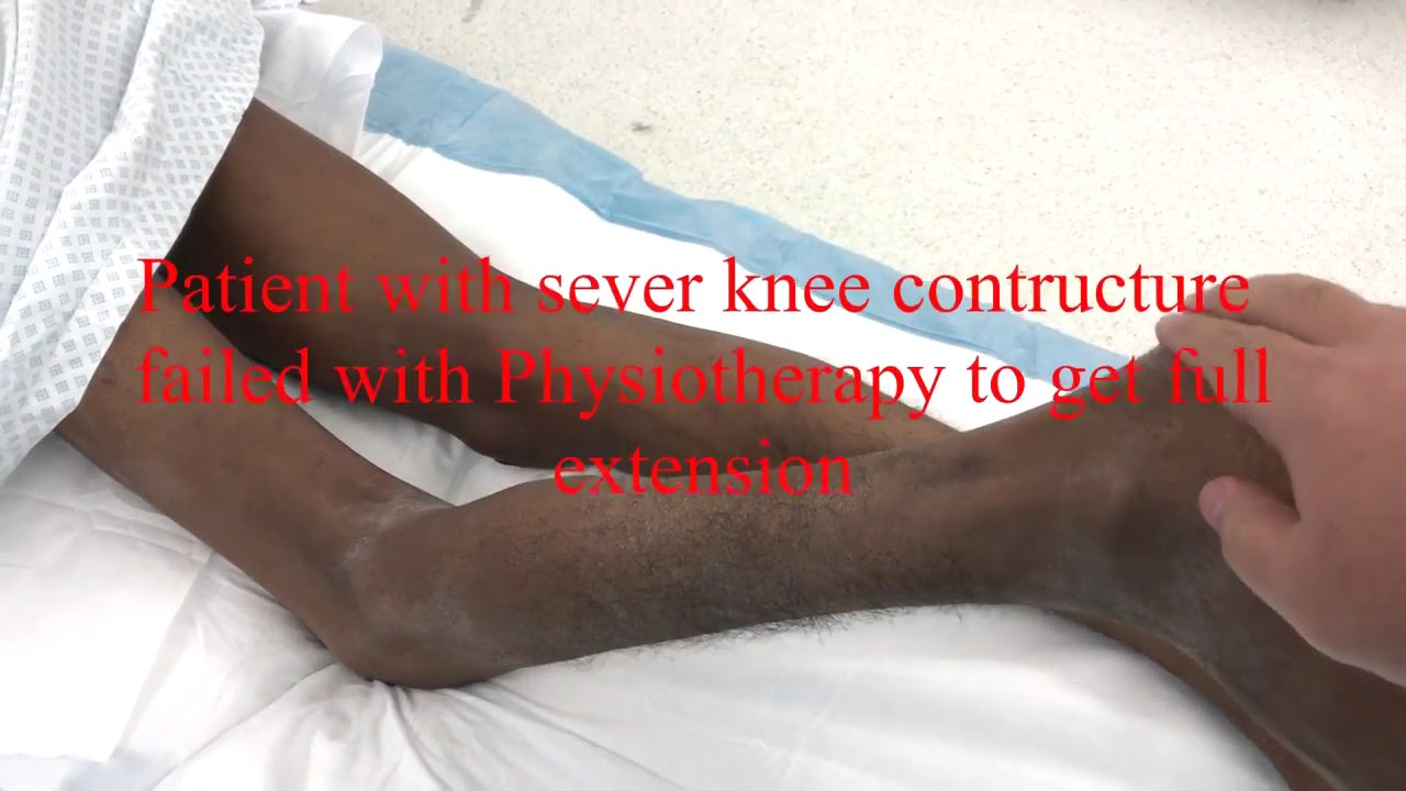 🔴 Precut Fasciotomy - Tenotomy For Knee Contracture | Shaket Dabous ...
