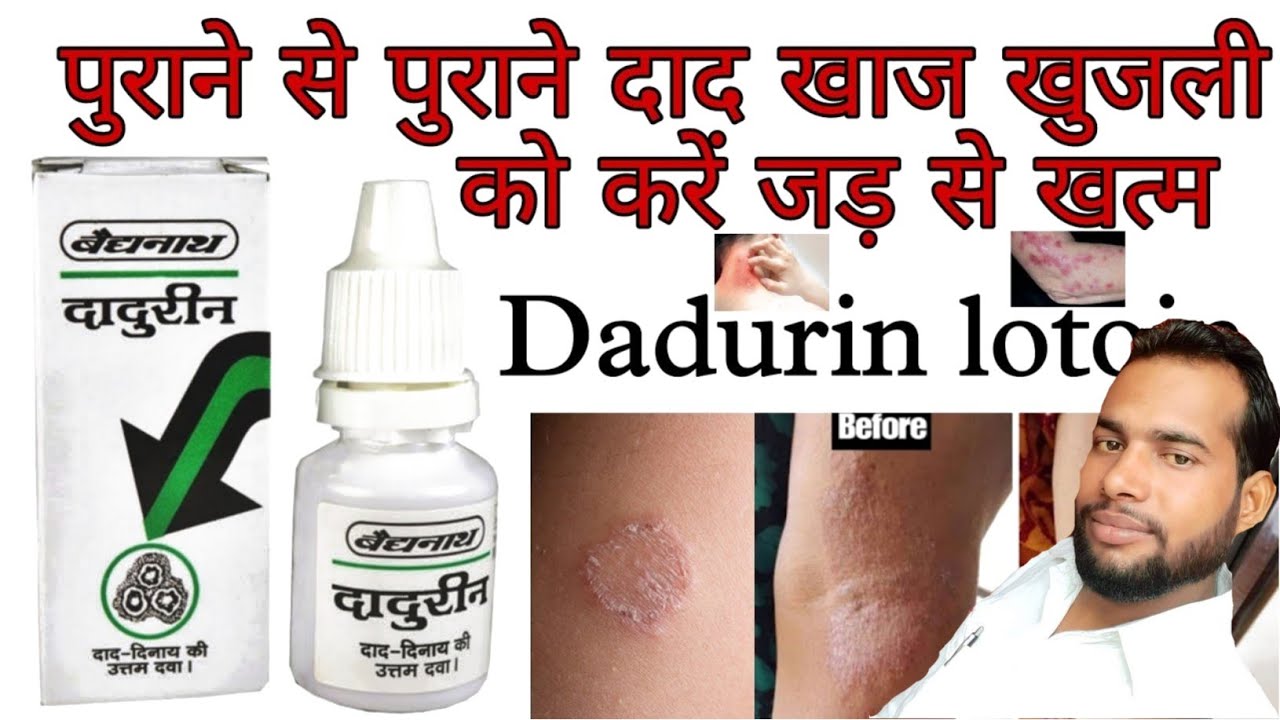 Dadurin lotion || Dadurin lotion uses in Hindi || दाद की दवा,दादुरीन ...