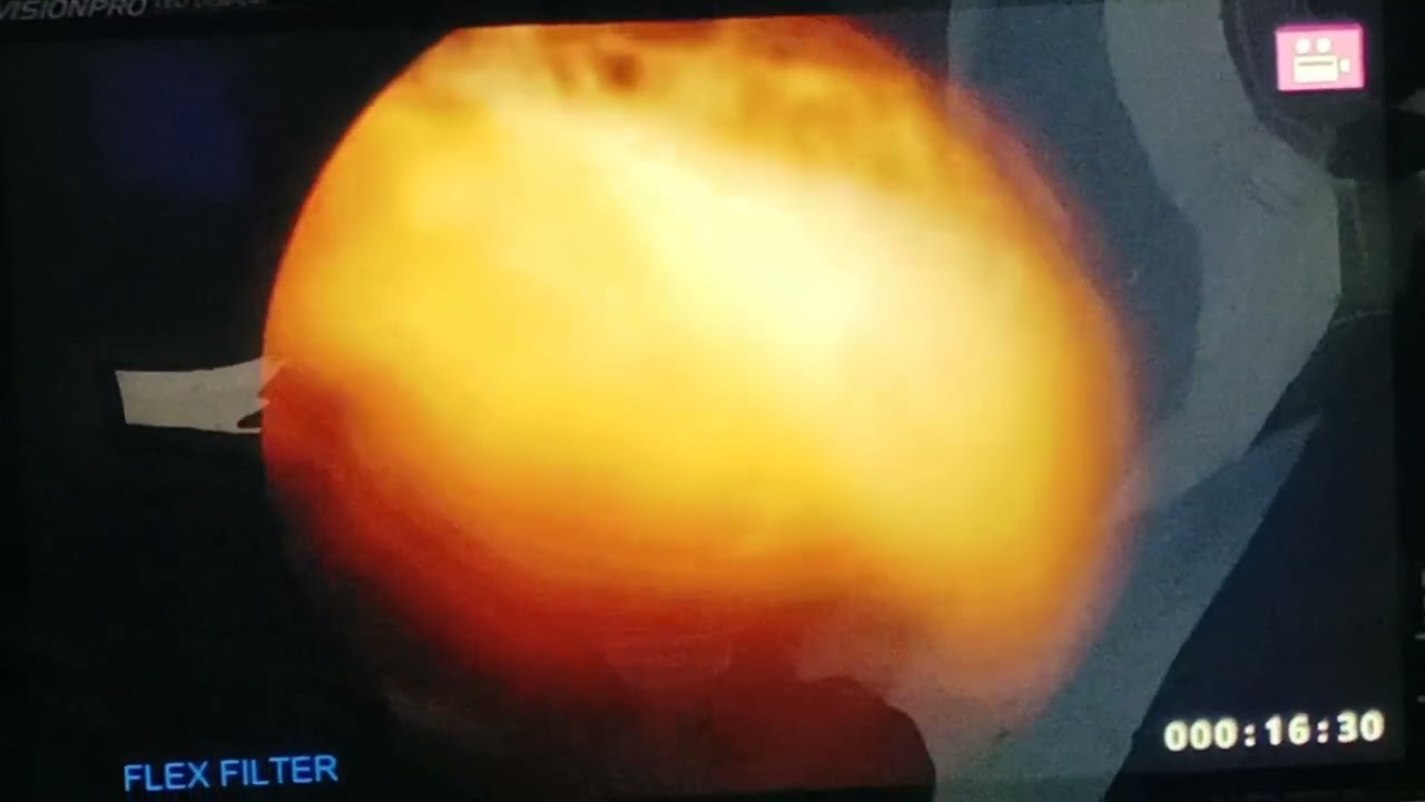 Cystolithotripsy of bladder stone using stone punch - YouTube