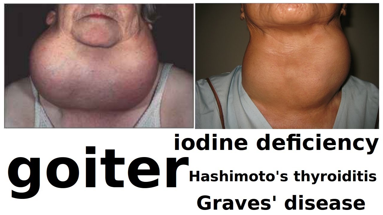 goiter - YouTube