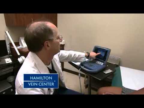 Varicose Vein Treatment in Houston | Hamilton Vein Center | Vein Center ...