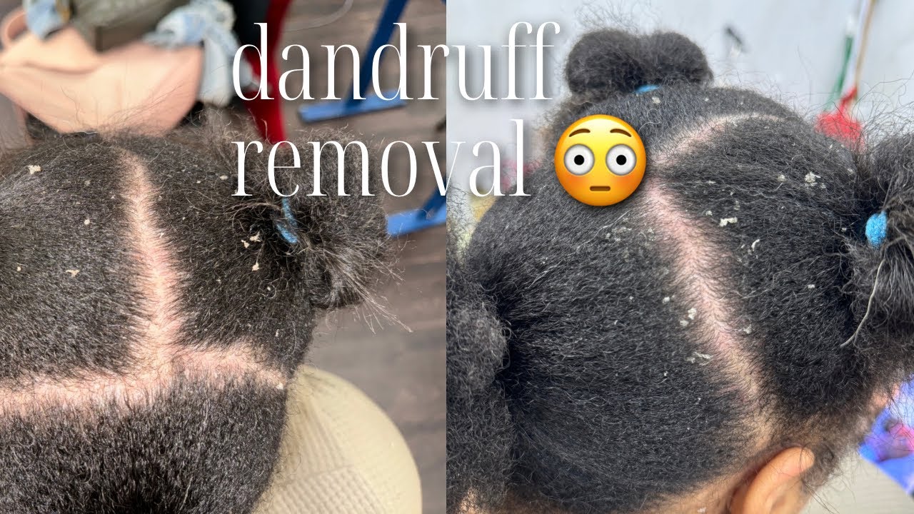 EXTREME DANDRUFF SCRATCHING!! I have the Dandruff CURE!! MUST WATCH ...
