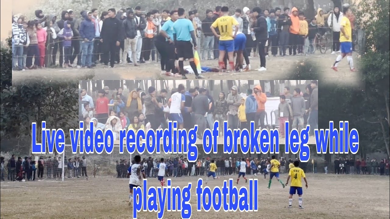 Live video recording of broken leg while playing football#football# ...