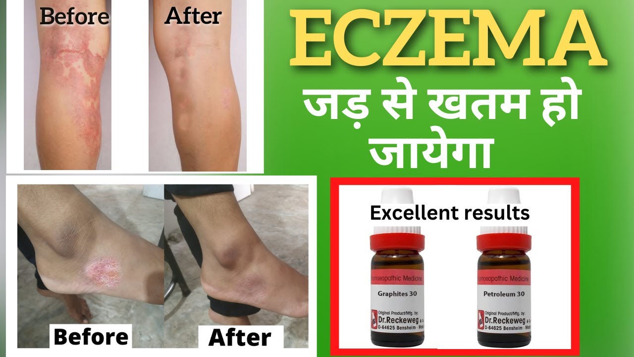 Homeopathic Treatment Of Eczema Eczema Ka Jad Se Ilaj Eczema homeopathic-treatment-of-eczema-eczema-ka-jad-se-ilaj-eczema