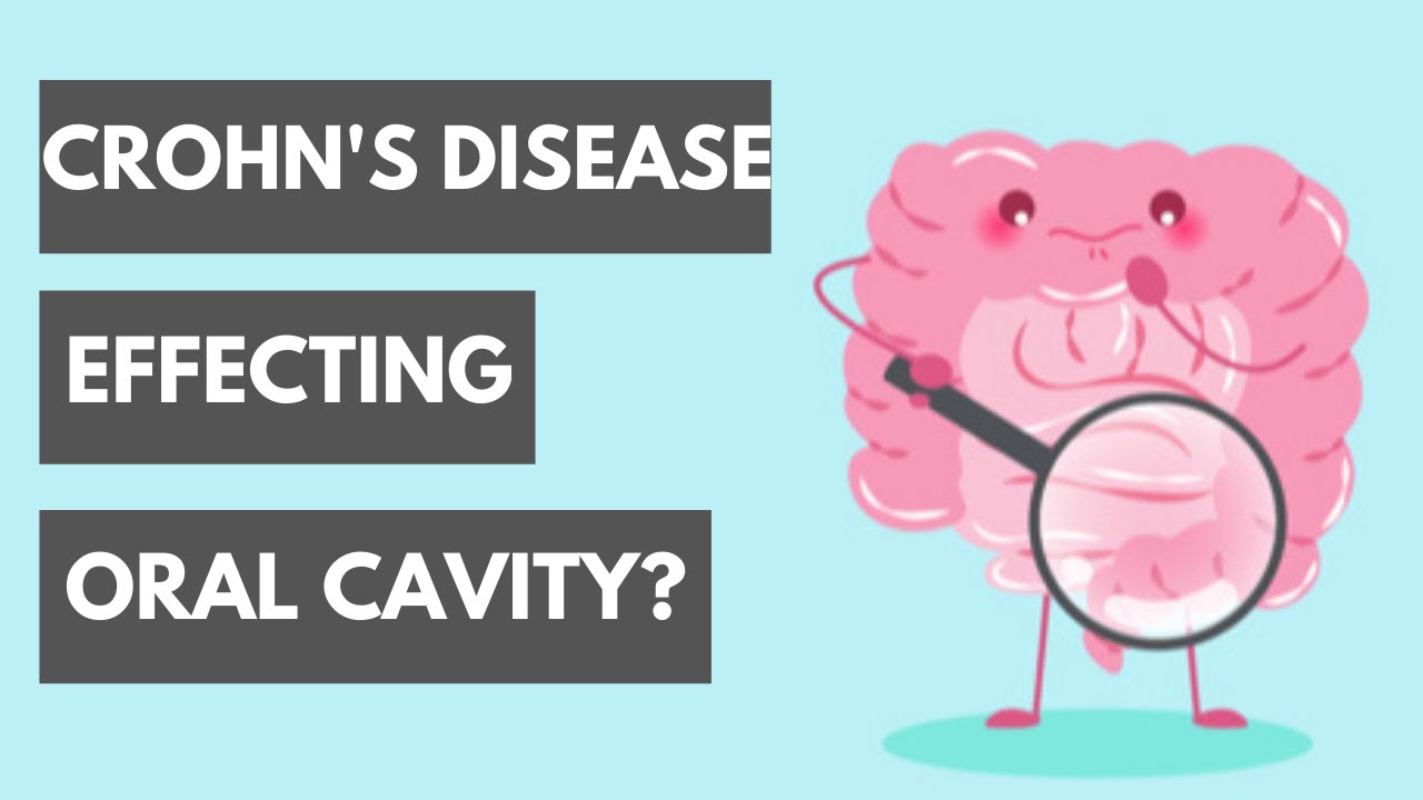 Crohn's Disease Effects Oral Cavity? Oral Manifestations of Systemic ...