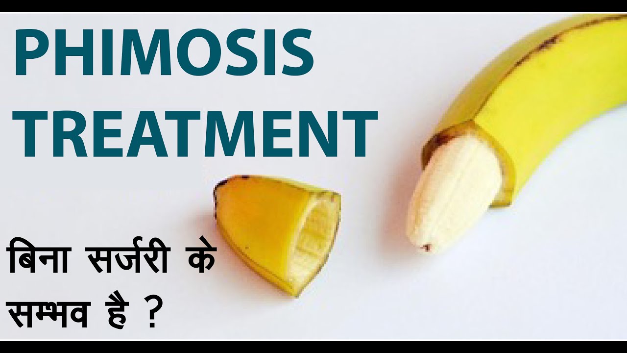 Total Circumcision in Complete phimosis | ZSR Circumcision Surgery ...