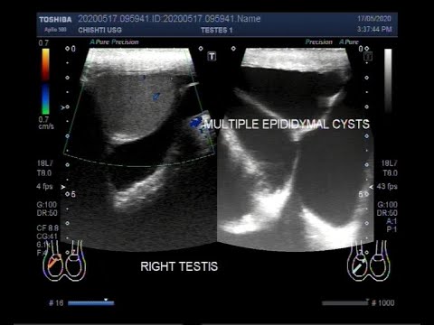 A Large multi-septic Epididymal cyst. - YouTube