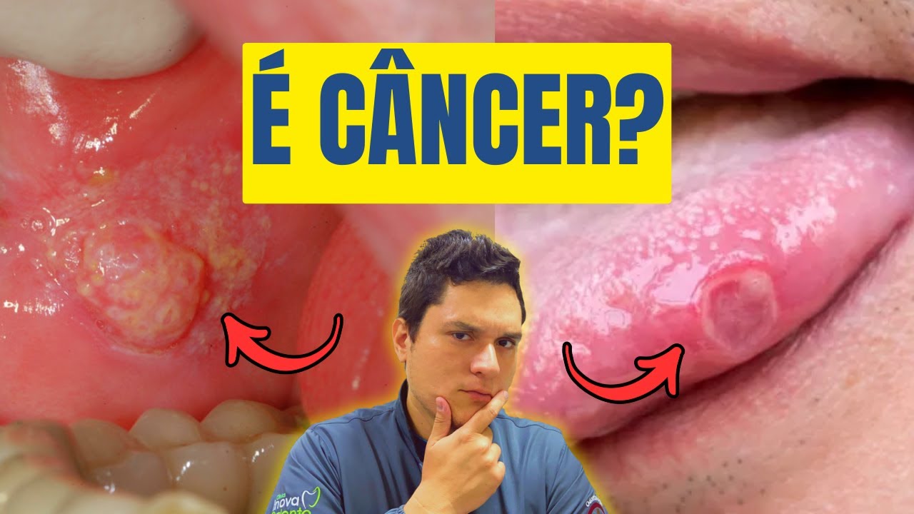 CÂNCER DE BOCA: SINAIS, SINTOMAS E TRATAMENTOS! - YouTube