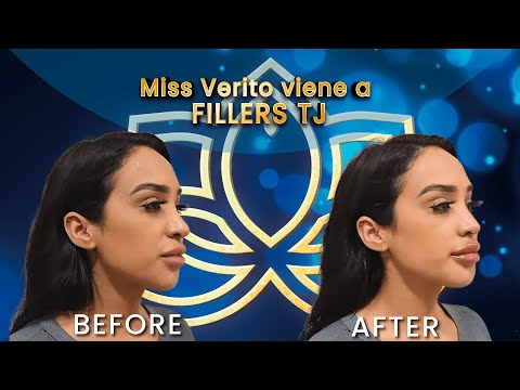 Miss Verito viene a FILLERS TJ
