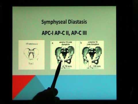 Symphyseal Diastasis and Symphysis Pubis Dysfunction Part 2 Jerry Hesch ...
