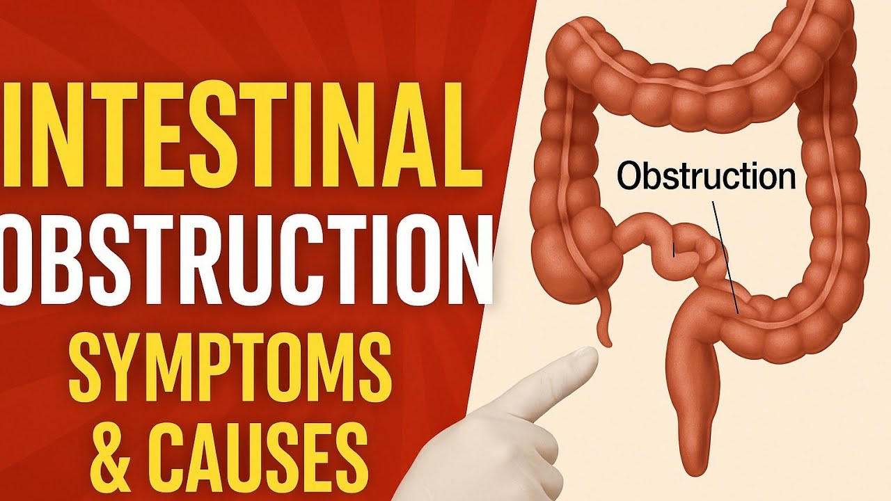 Intestinal Obstruction: Deadly Signs You Must Know! 🚨 - YouTube