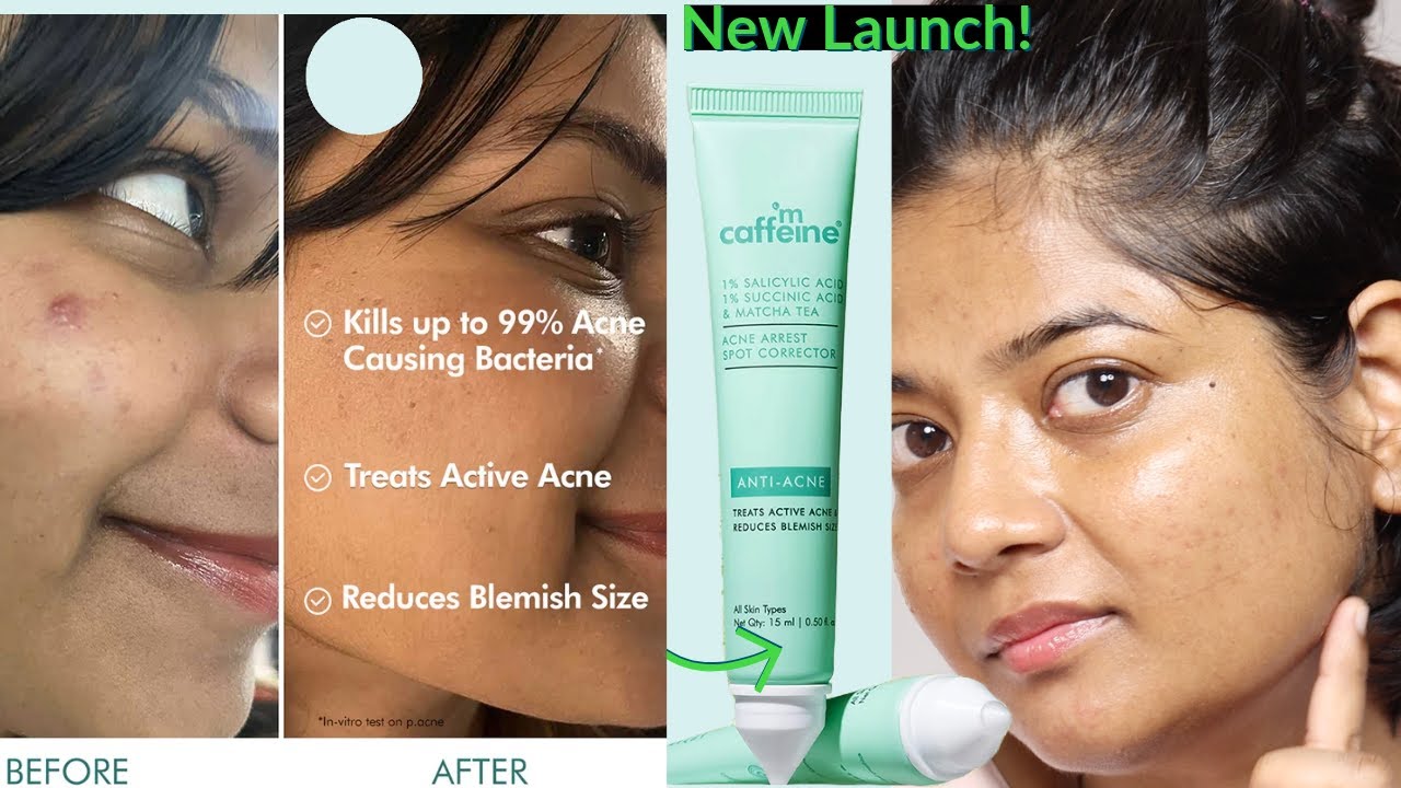 Mcaffeine Acne Spot Corrector Review | Treats Active Acne | Reduces ...