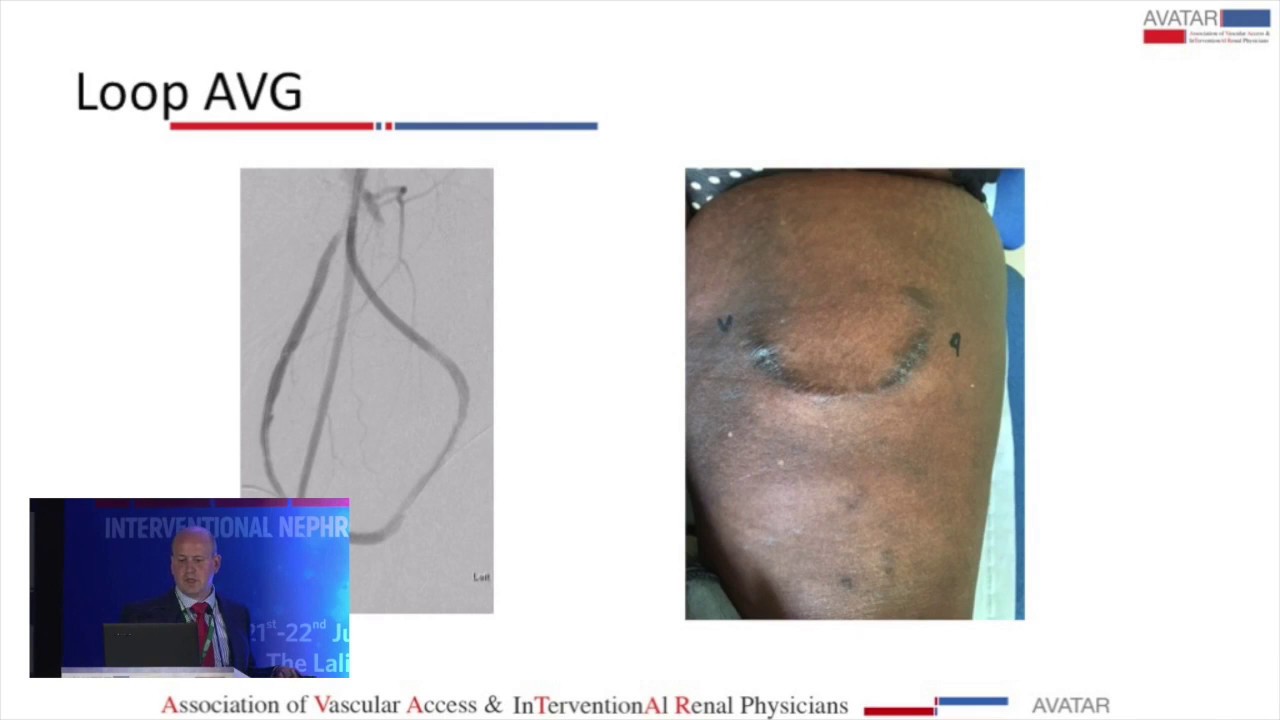 How to create Fistula when all ideal options exhausted - YouTube