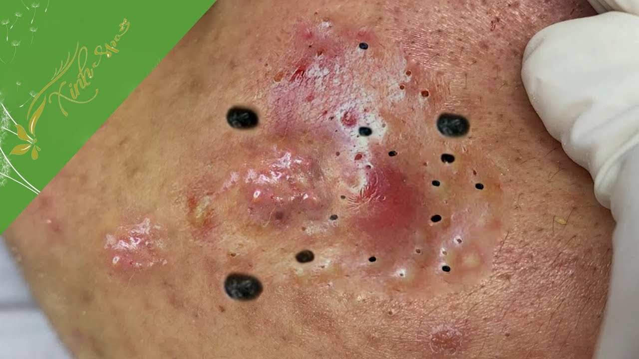 Relax Every Day with Xinh Spa Acne Treatment 8#122 - YouTube