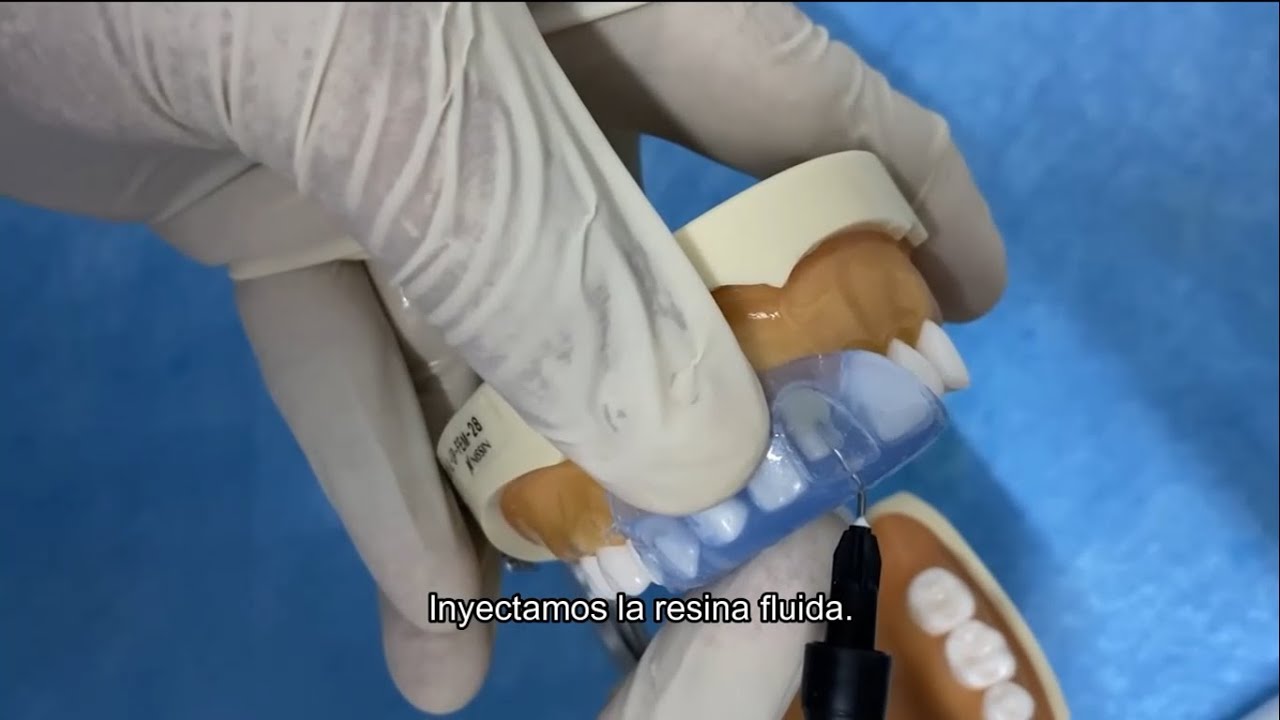 TUTORIAL: Provisionales con técnica de Resina Inyectada - YouTube