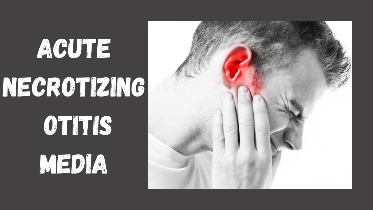 Acute Necrotizing Otitis Media | Very Easy - YouTube