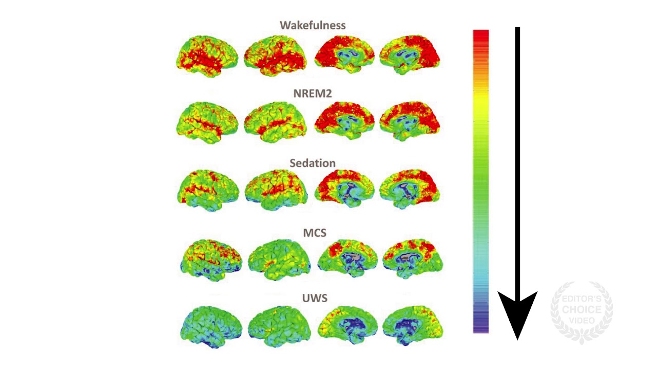 Disrupted global brain signal during unconsciousness - YouTube