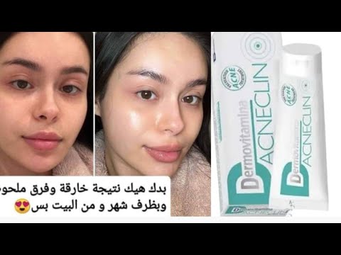 خلى وشك ينور 🌿كريم اكنيلين تفتيح البشره بياض الثلج Acnelin لحب الشباب ...
