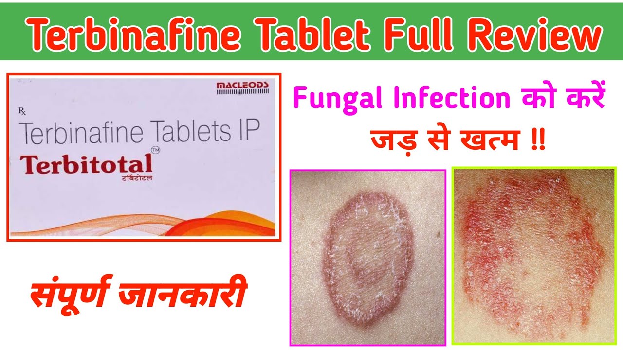 Terbitotal Tablet / Terbinafine 250mg tablet / Terbitotal tablet uses ...