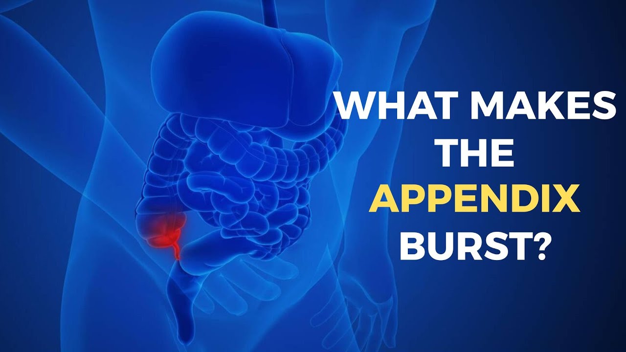What Does Appendicitis Pain Feel Like? A Guide to Early Detection - YouTube