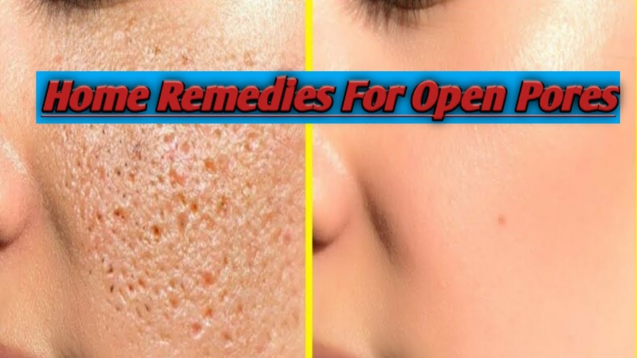 BEST HOME REMEDIES FOR OPEN PORES | GET RID OF OPEN PORES NATURALLY AT ...