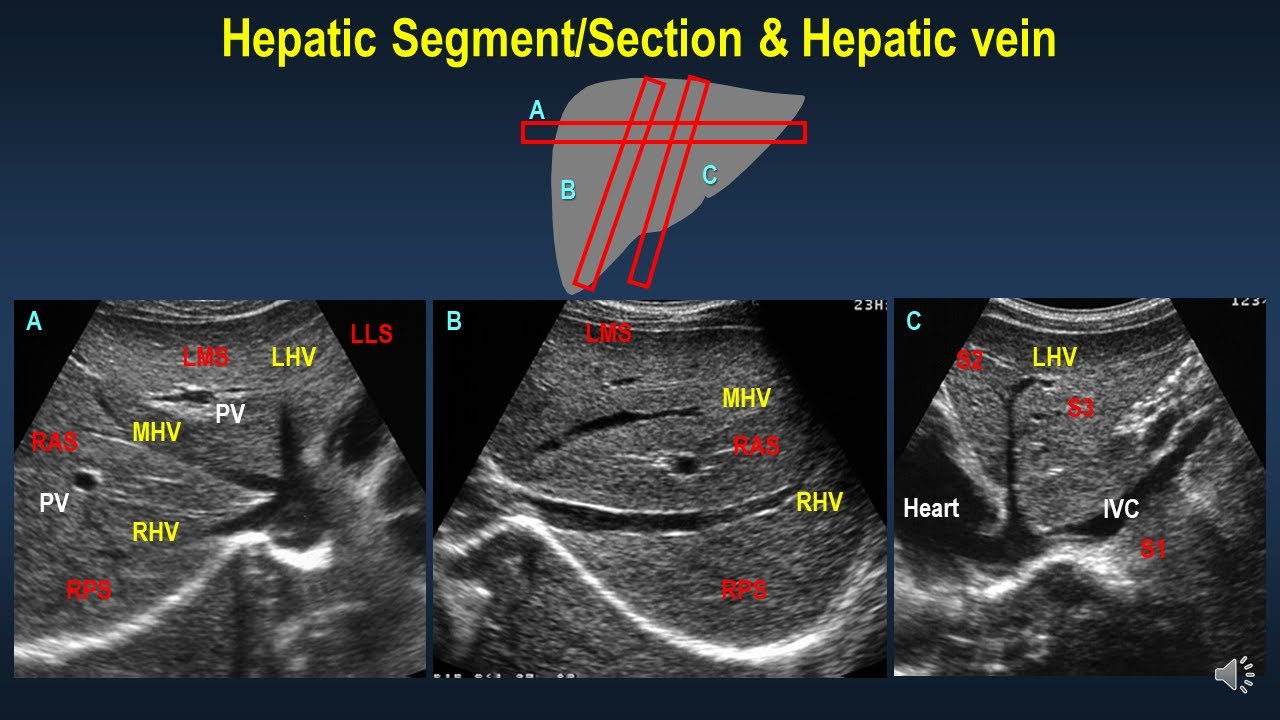 간질환의 영상진단 1 - liver imaging examinations - YouTube