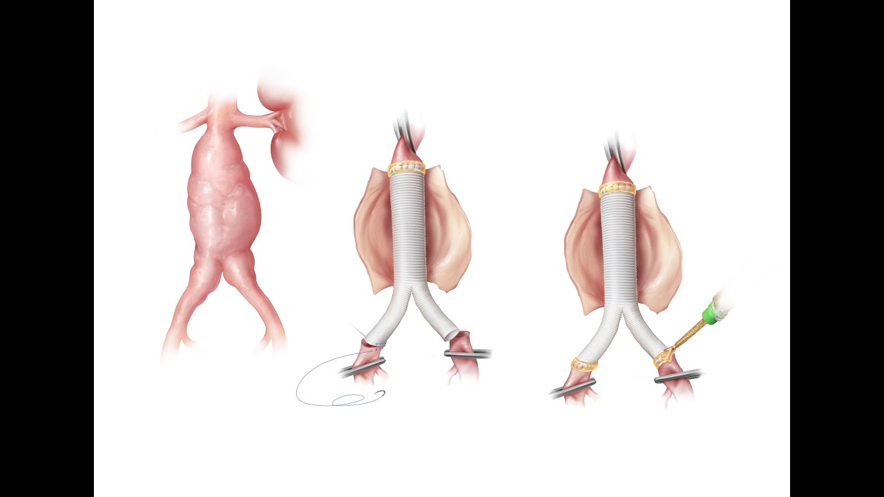 BioGlue Surgical Sealant Application Technique in Vascular Surgery ...