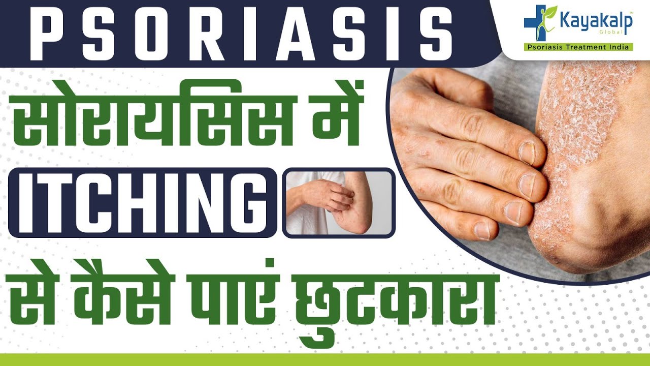 Psoriasis(सोरायसिस) में Itching se छुटकारा कैसे पाए | Home Remedies for ...