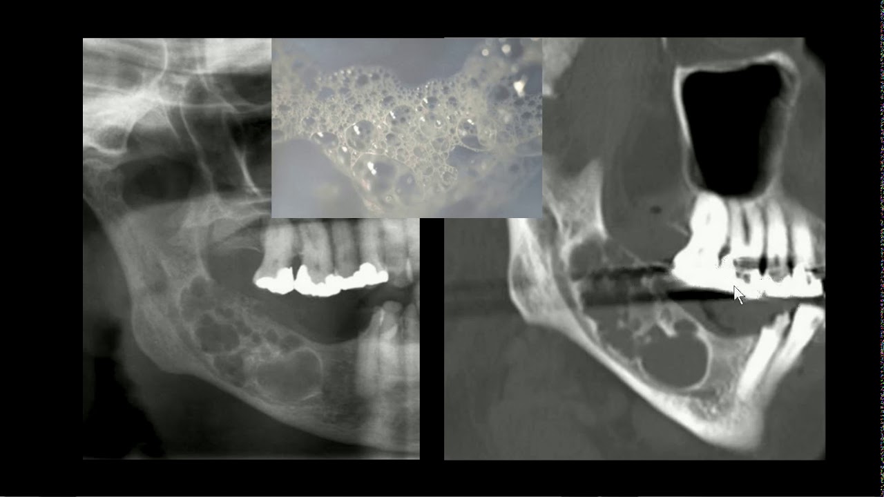 Ameloblastoma - YouTube