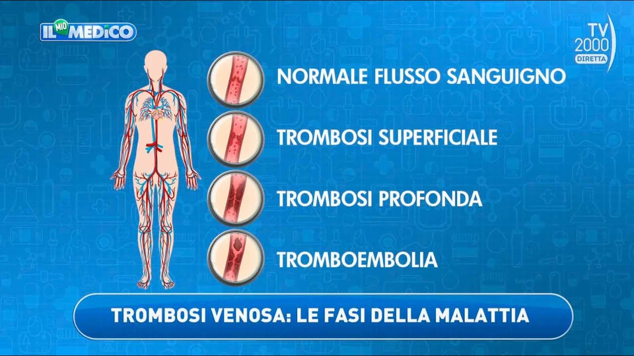 Il Mio Medico (Tv2000) - Come riconoscere e curare una trombosi - YouTube