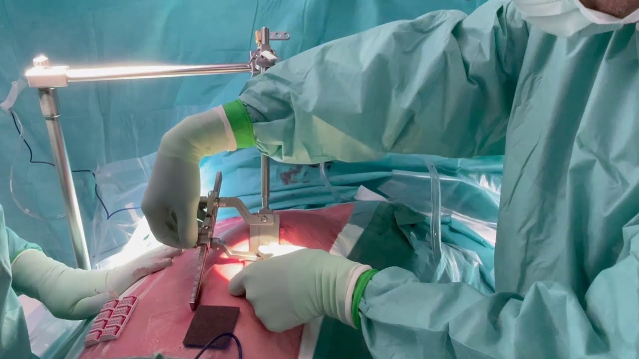 How to Perform MIDCAB Using BIMA - YouTube