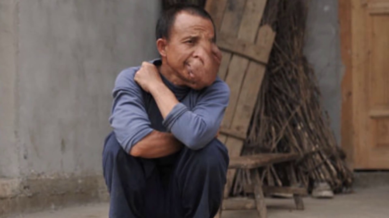 World's Worst Tumors and Cysts; Chinese Elephant Man - YouTube