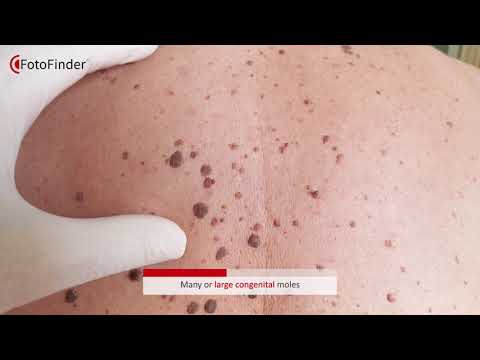 Total Body Mapping ATBM master FotoFinder Systems - YouTube