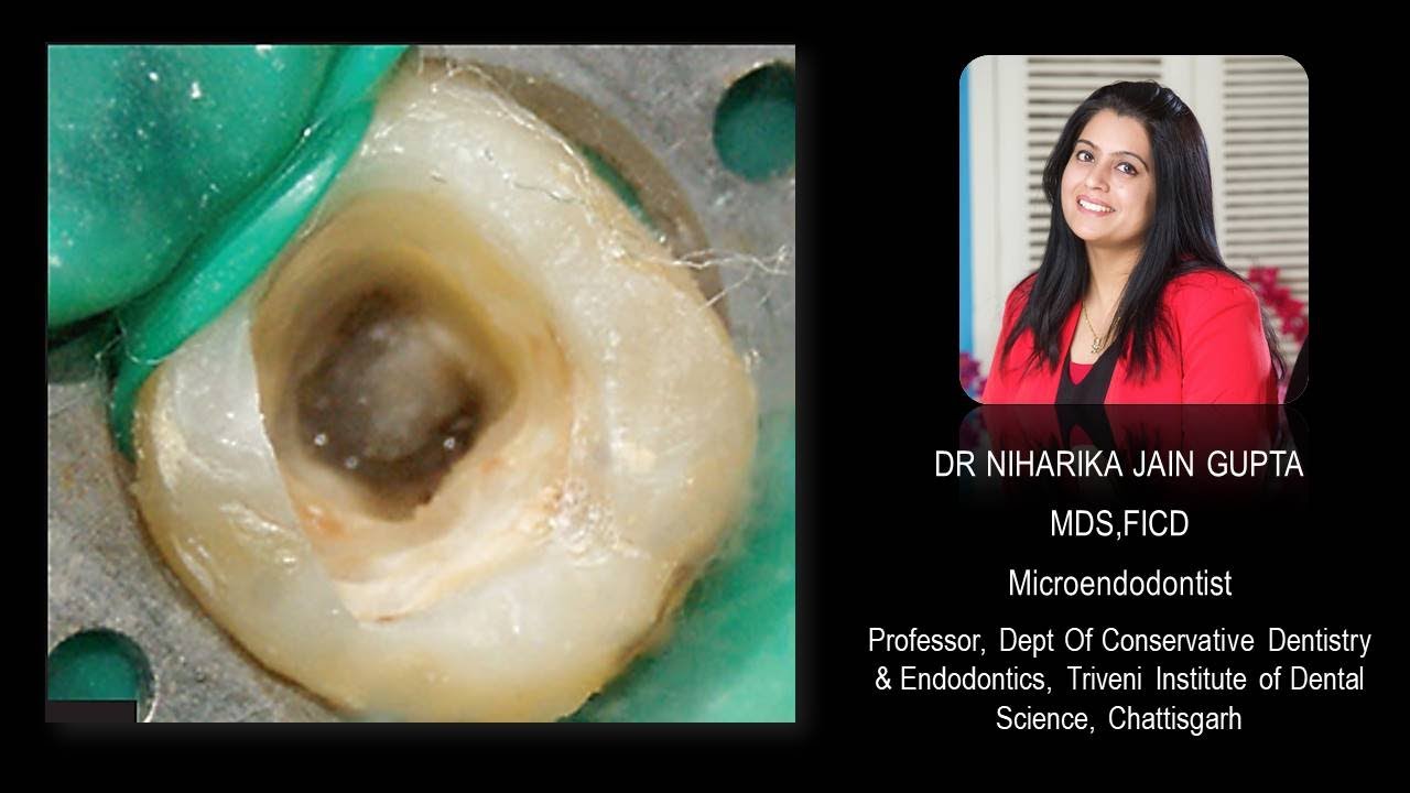 Endodontic Access opening : FROM CONVENTIONAL TO CONTEMPORARY - YouTube