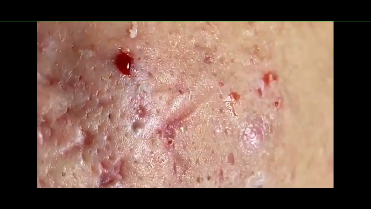 Blackheads On Nose Removal| pimples and Blackheads removal on face at ...
