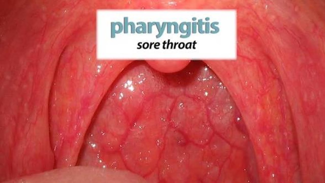 ASSESSMENT AND DIAGNOSTICS 75: Pharyngitis, Herpes, Kidney Imbalances ...