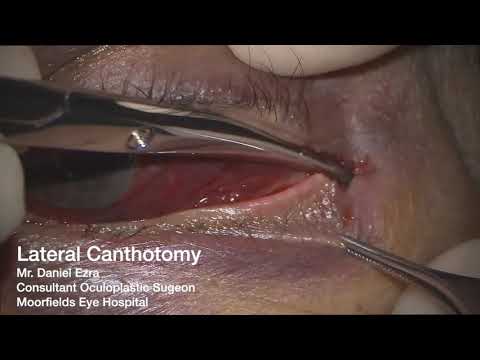 Lateral Canthotomy / Cantholysis: Two step technique