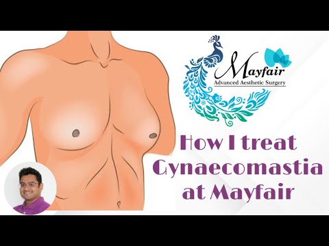 How I Treat Gynaecomatia at Mayfair Dr Kedarnath Pandya Ahmedabad Vadodara Rajkot Bhavnagar Deesa