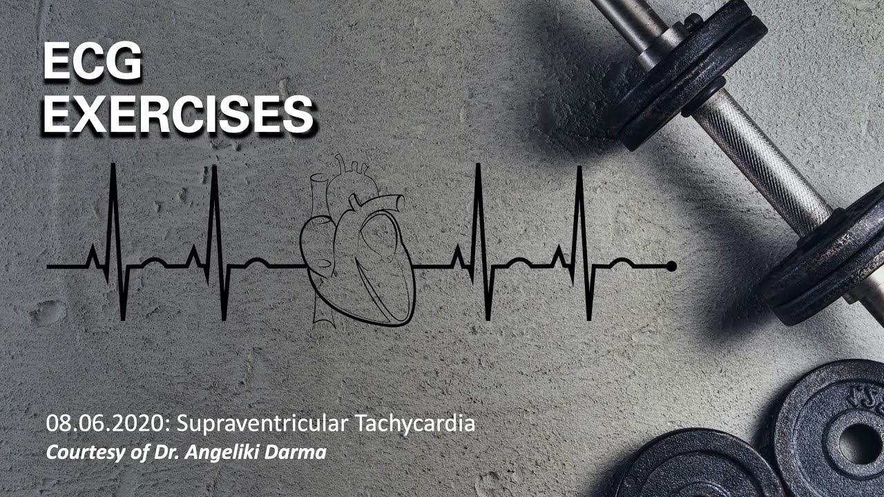 ECG Exercise: SVT, what is the mechanism and where is the origin of the ...