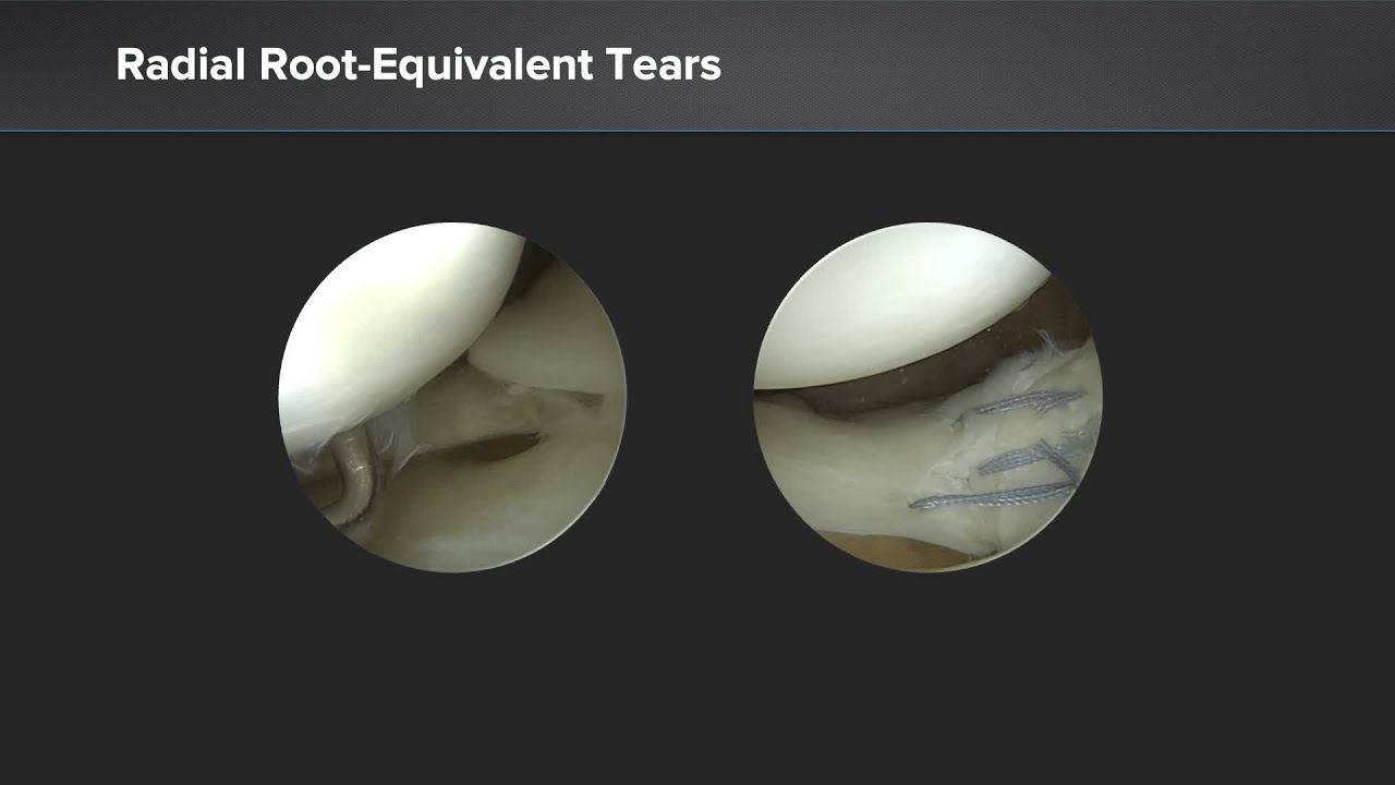 My Approach to Ramp Lesions, Radial Tears, and Meniscal Root Tears ...