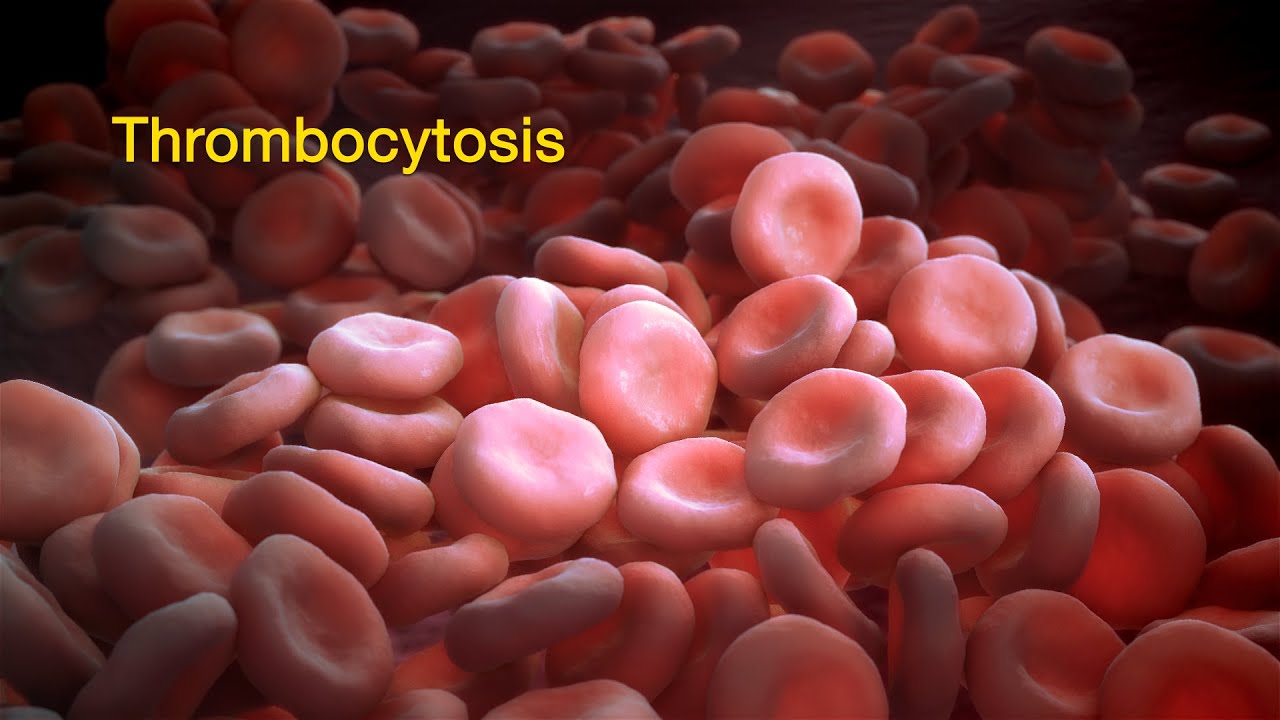 High Platelet Count Causes: What is Thrombocytosis? - YouTube