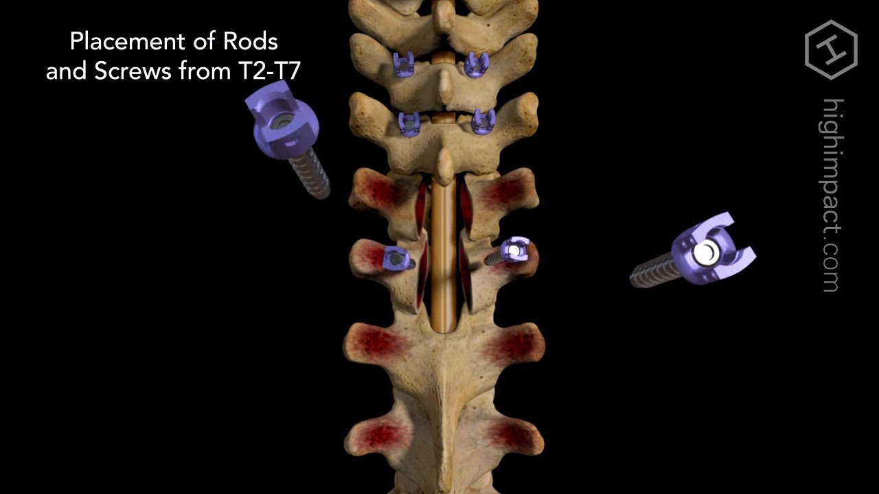 Open Reduction Internal Fixation of T4 with Posterolateral Fusion from ...