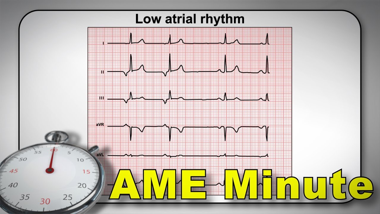 AME Minute: Identification of ECG Normal Variants Reduces Delays - Part ...
