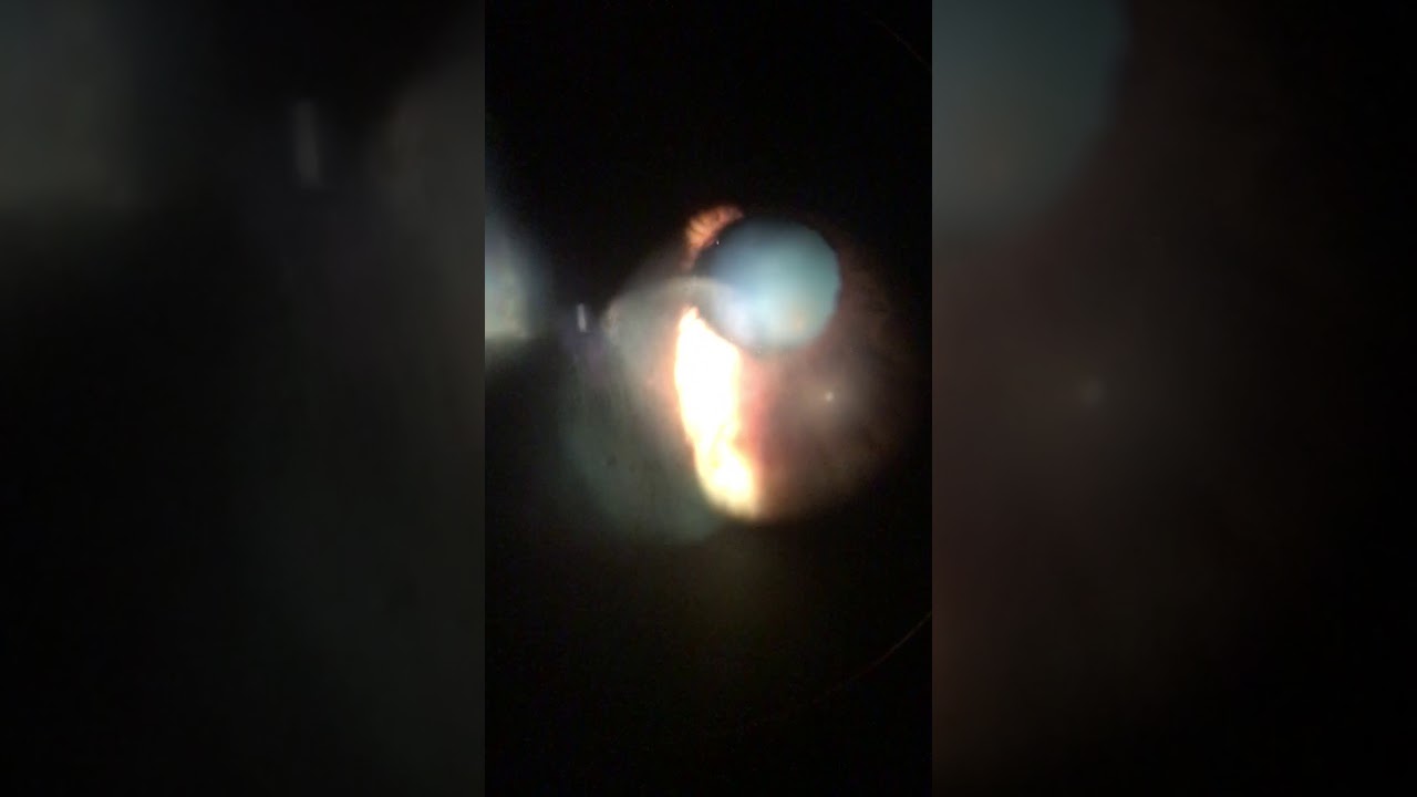 SUB EPITHELIAL INFILTRATES by viral corneal infection - YouTube