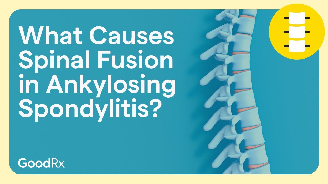 Bamboo Spine Caused by Ankylosing Spondylitis | GoodRx - YouTube