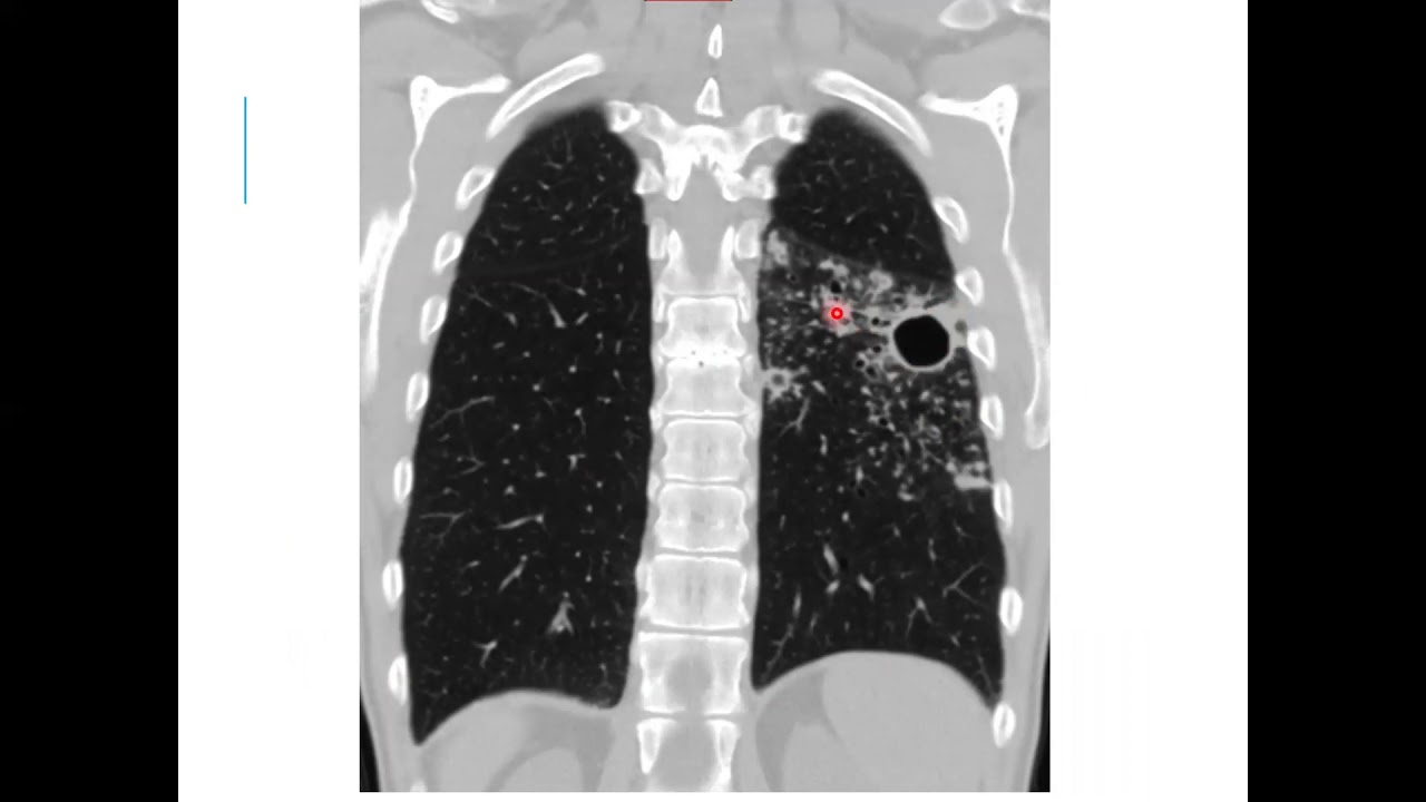 Hallazgos radiológicos y tomograficos de Tuberculosis - YouTube