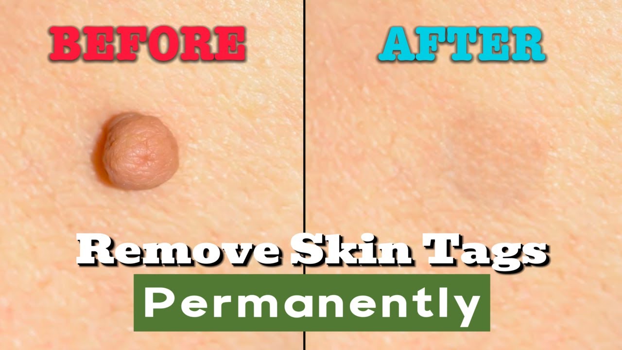 5 Fast Home Remedies to Remove Skin Tags & Warts - YouTube