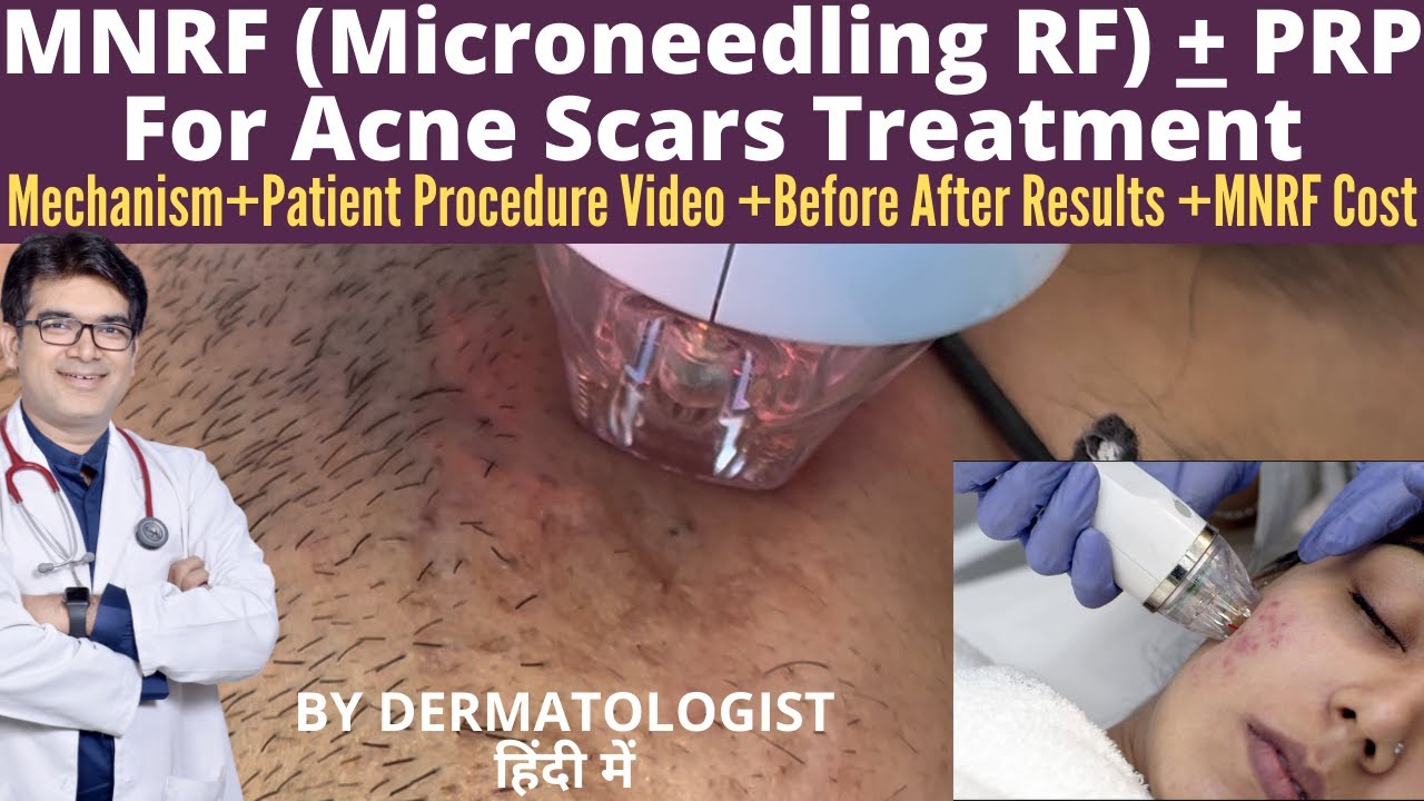Microneedling RF MNRF Treatment For Acne Scars | MNRF Skin Treatment ...