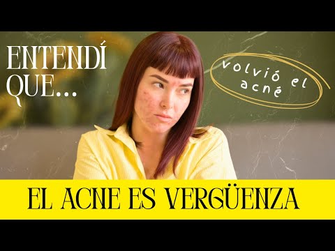 Tuve OTRO episodio de ACNÉ y esto fue lo que me curó